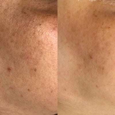 Hydro-Glo Peel Pads 40% – Perfect Image