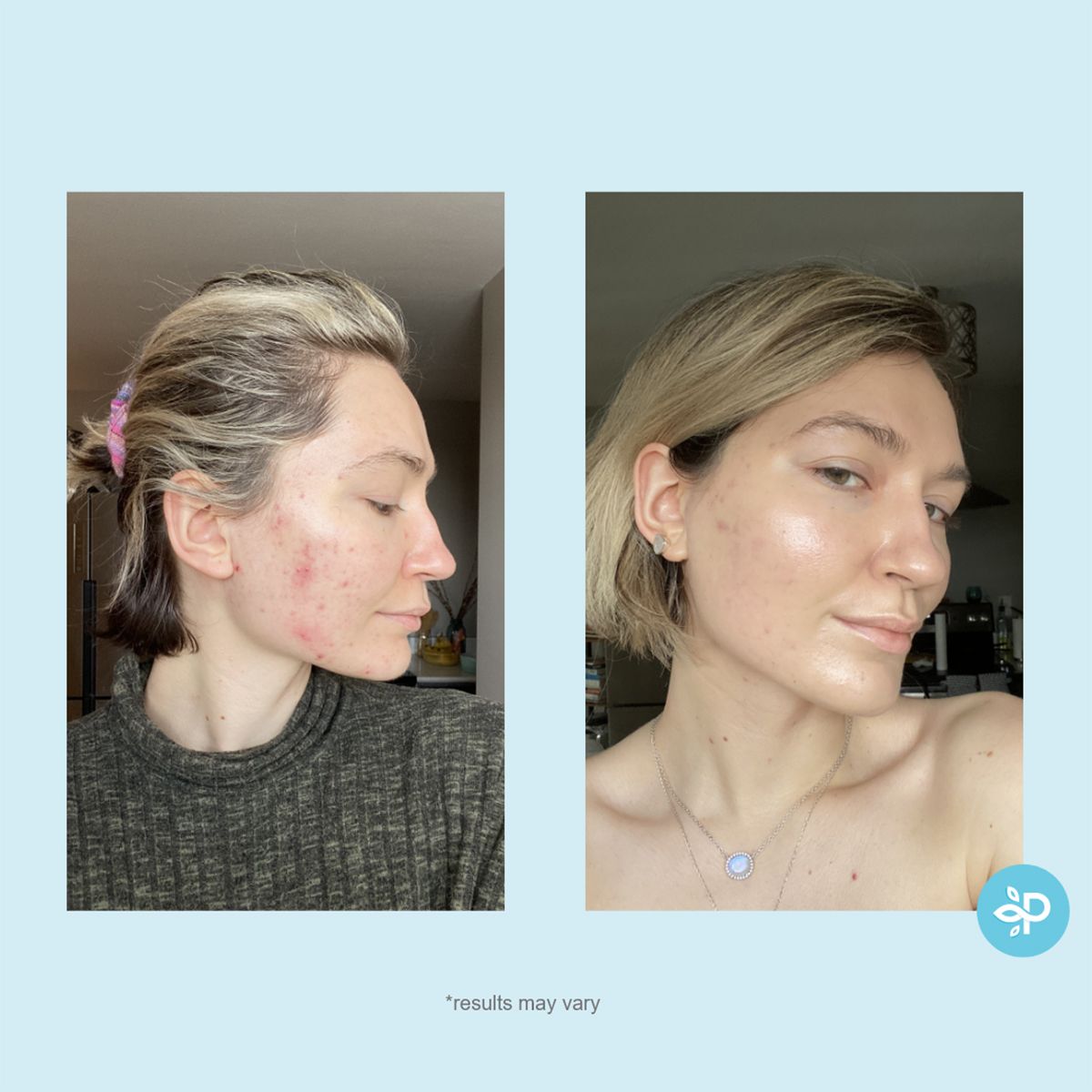 Hydro-Glo Peel Pads 10% – Perfect Image